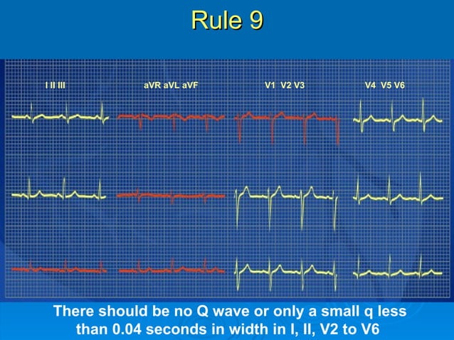 Easy to read ekg, how to read, how to representation | PPT