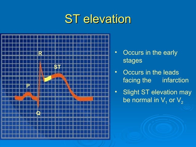 Easy to read ekg, how to read, how to representation | PPT