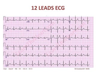 Easy ECG INTERPRETATION | PPTX