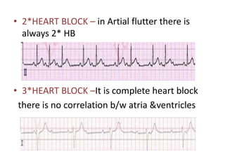 Easy ECG INTERPRETATION | PPTX