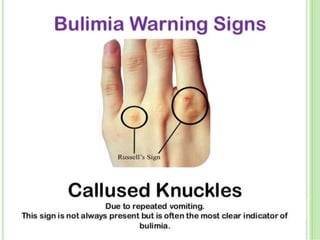 Russells Sign Bulimia