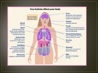 Common Eating Disorders Presentation | PPT