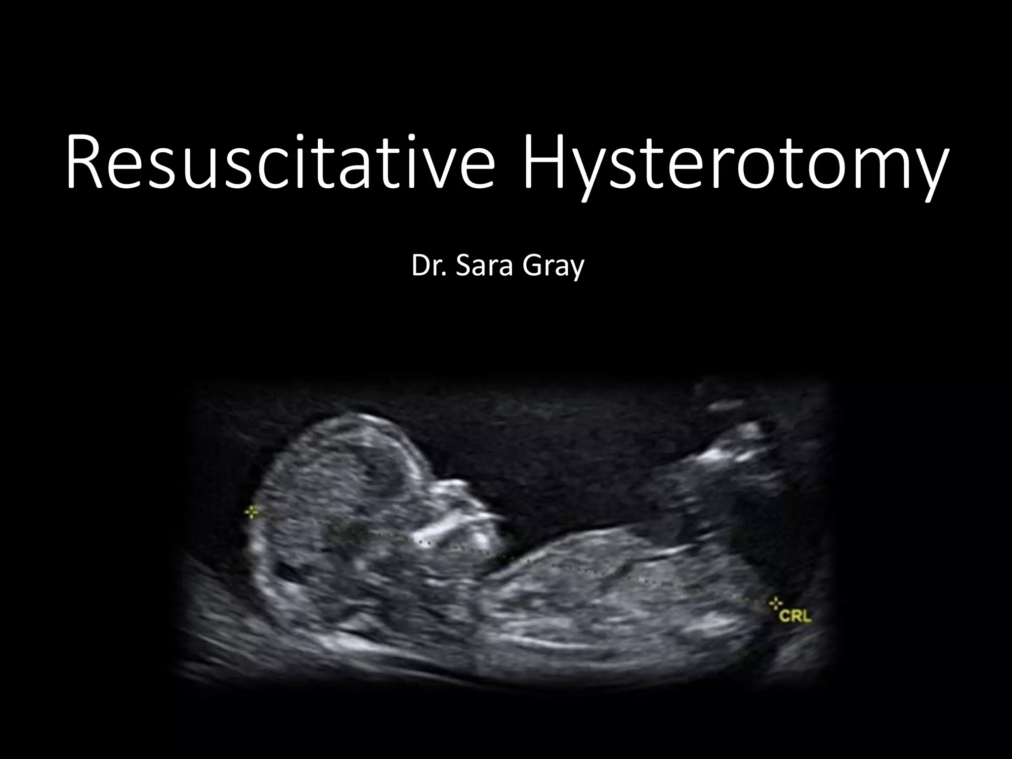 Resuscitative Hysterotomy: Sara Gray | PPTX