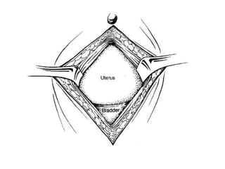 Resuscitative Hysterotomy: Sara Gray | PPT