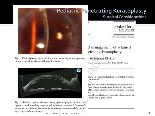 Pediatric Penetrating Keratoplasty | PPT
