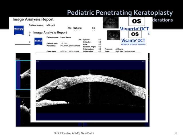 Pediatric Penetrating Keratoplasty | PPT