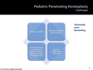 Pediatric Penetrating Keratoplasty | PPT