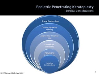 Pediatric Penetrating Keratoplasty | PPT