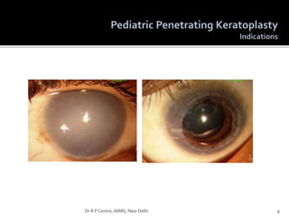 Pediatric Penetrating Keratoplasty | PPT