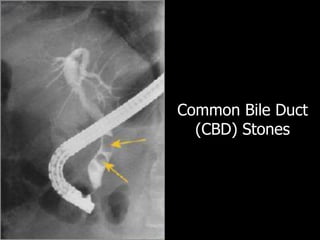 Approach to Common Bile Duct Stones | PDF