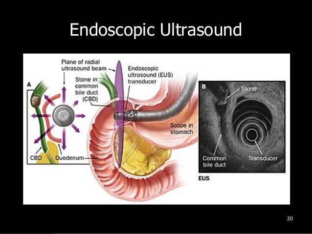 Approach to Common Bile Duct Stones