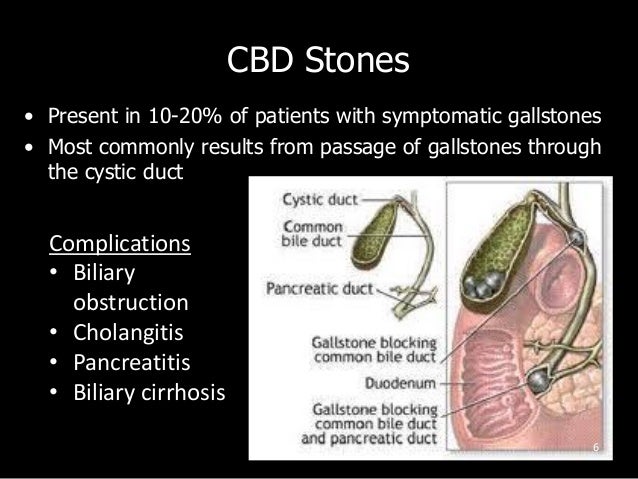 Approach to Common Bile Duct Stones