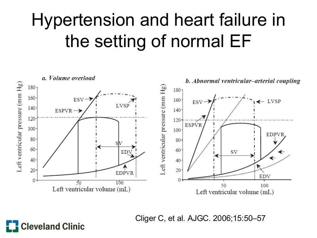 Heart failure with preserved ejection fraction Heart failure with preserved ejection fraction