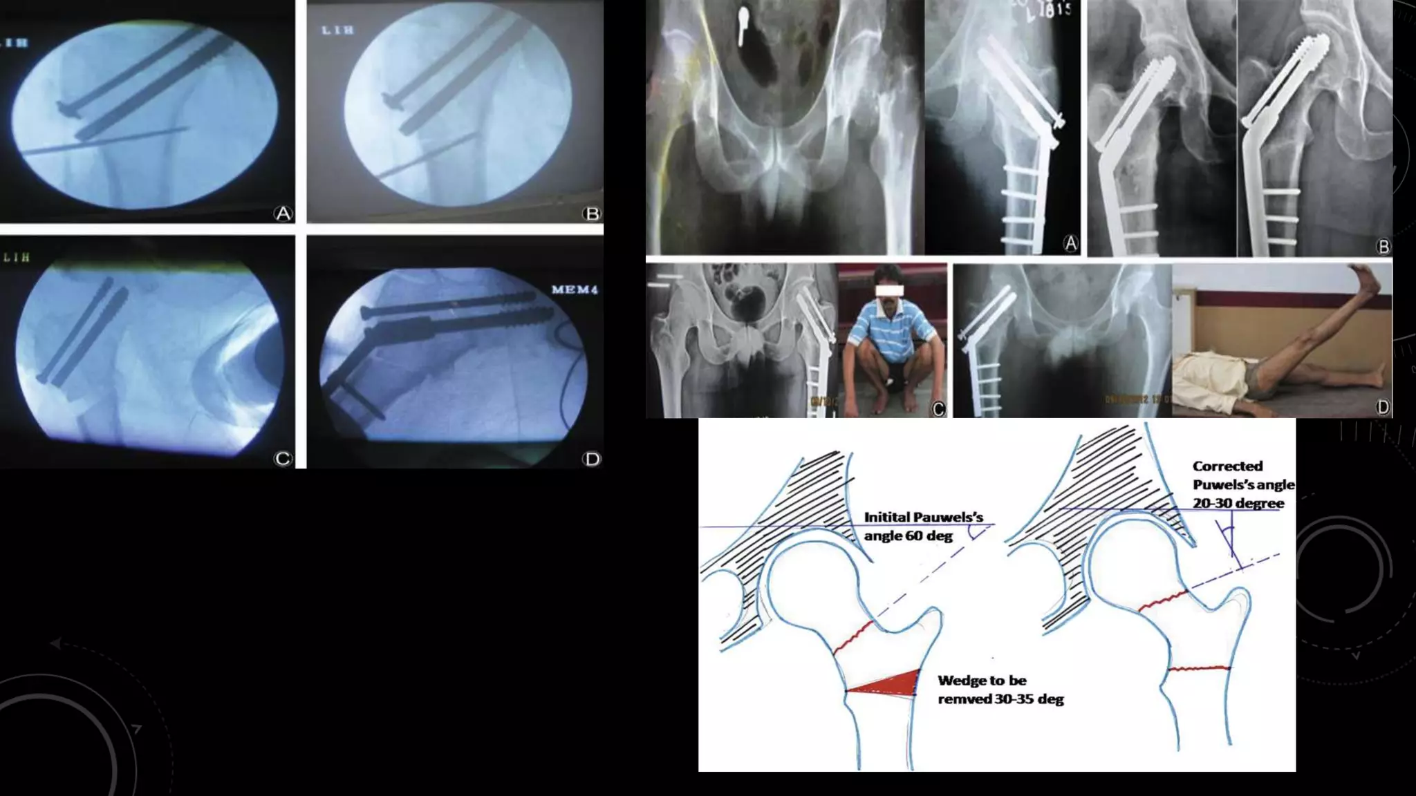 Ebm of non union of neck of femur fracture | PPT