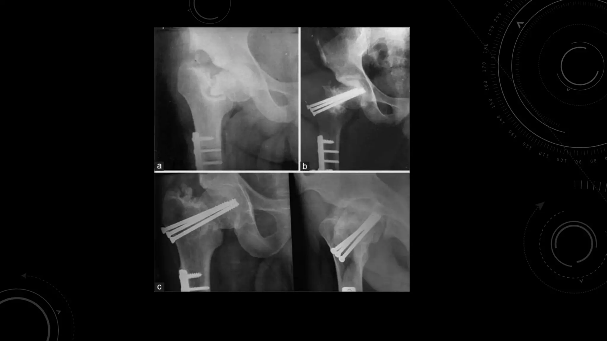 Ebm of non union of neck of femur fracture | PPT