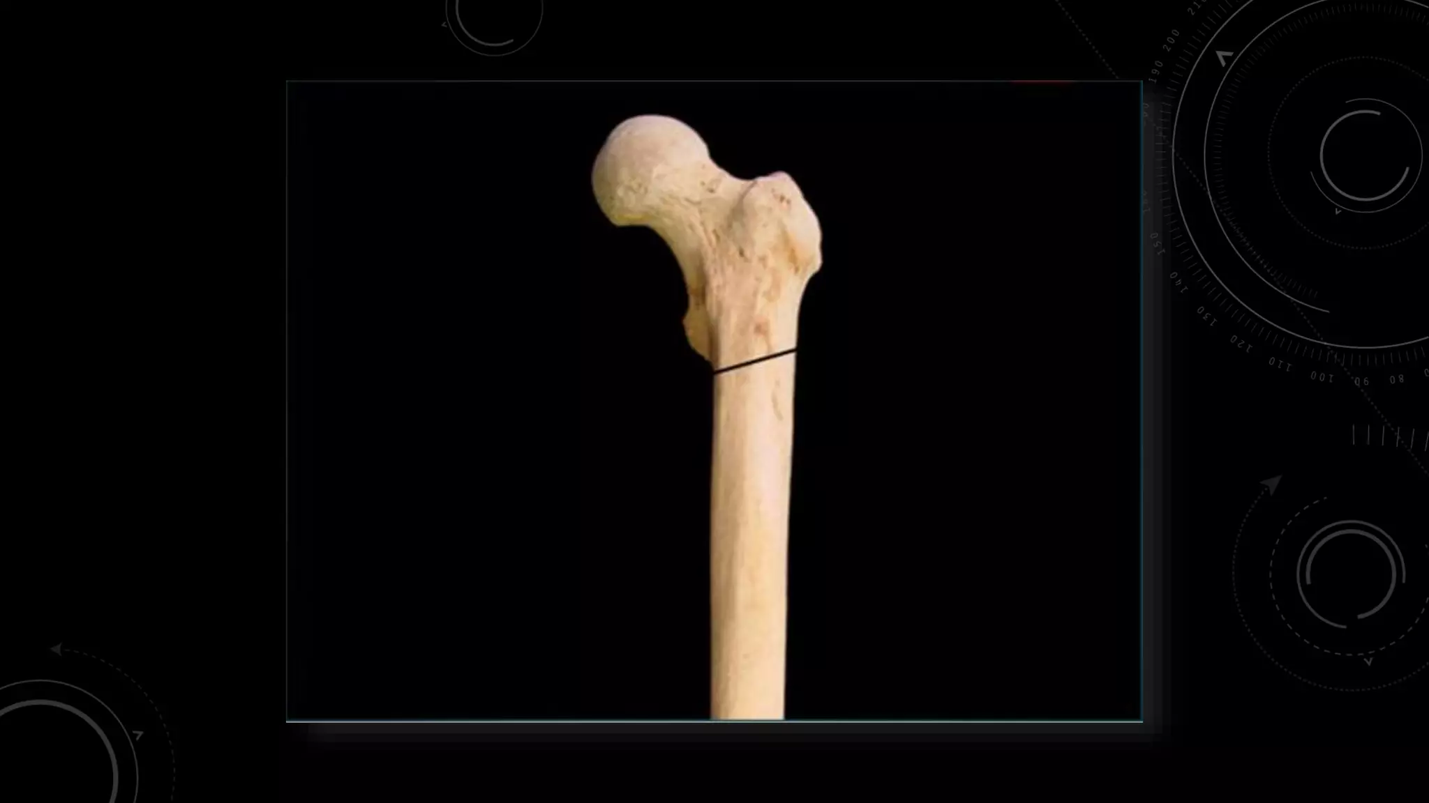 Ebm of non union of neck of femur fracture | PPT