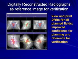 EBRT and brachytherapy radiology go3.ppt