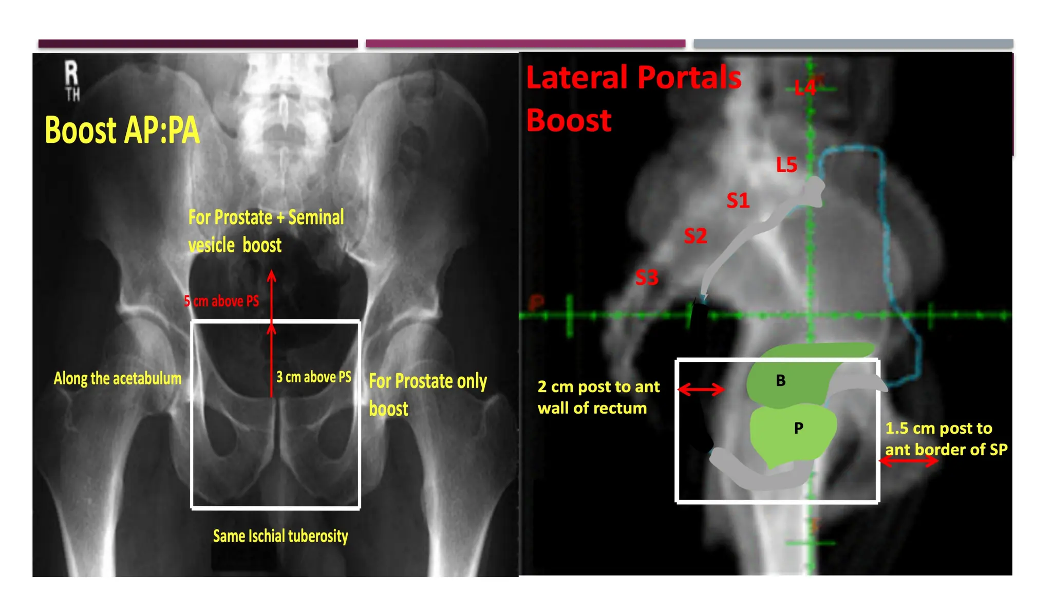 External Beam RT IN CArcinoma PROSTATE.pptx