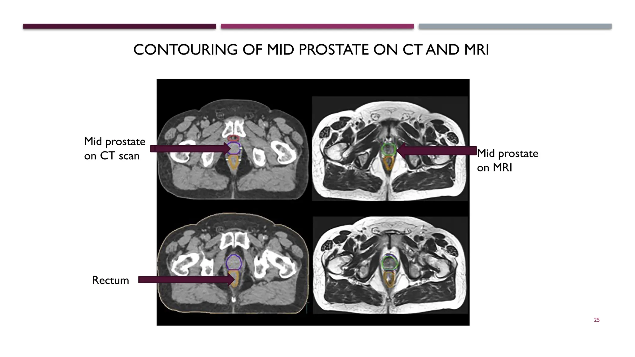 External Beam RT IN CArcinoma PROSTATE.pptx