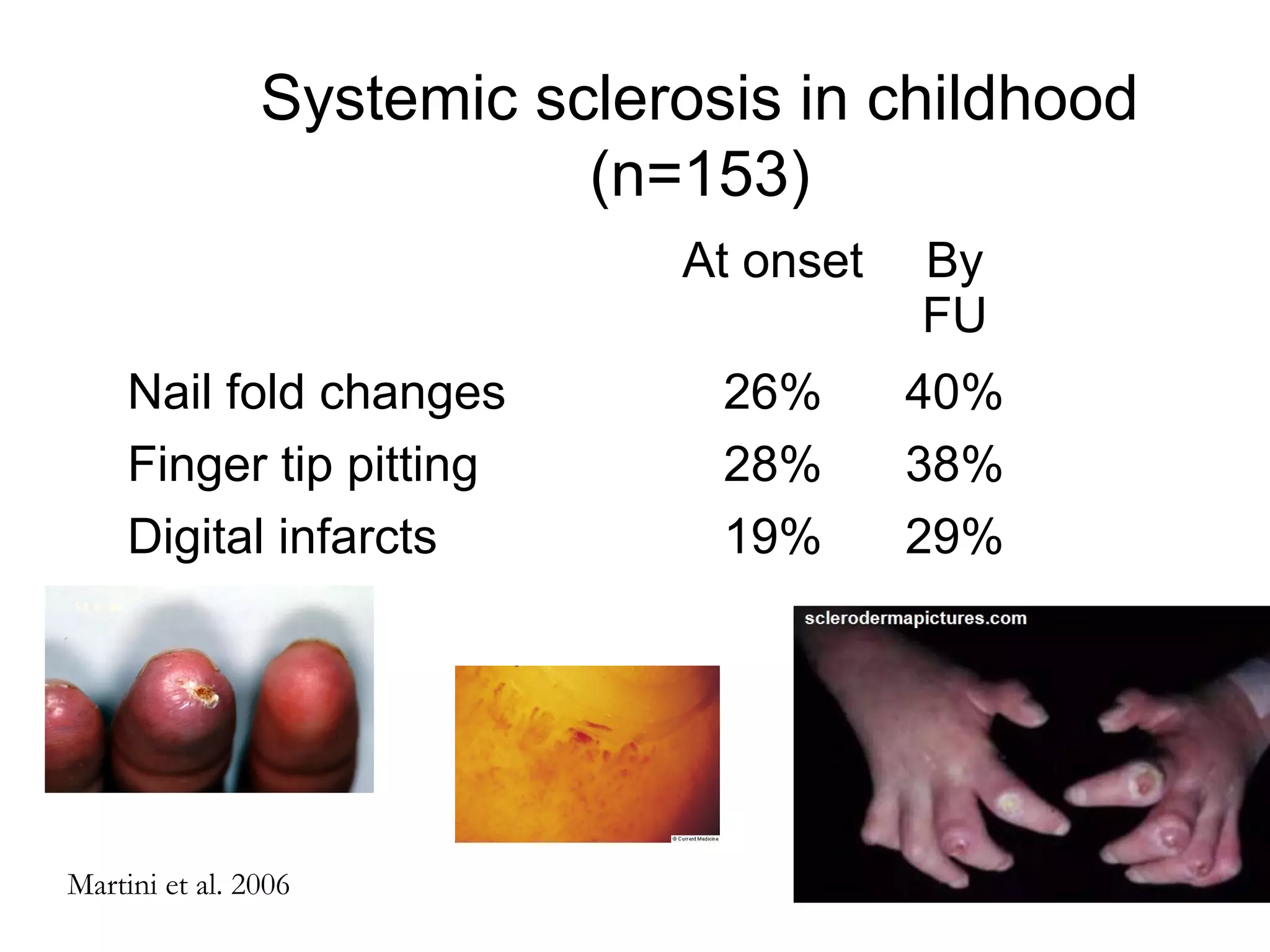 Scleroderma in children and young people | PPT