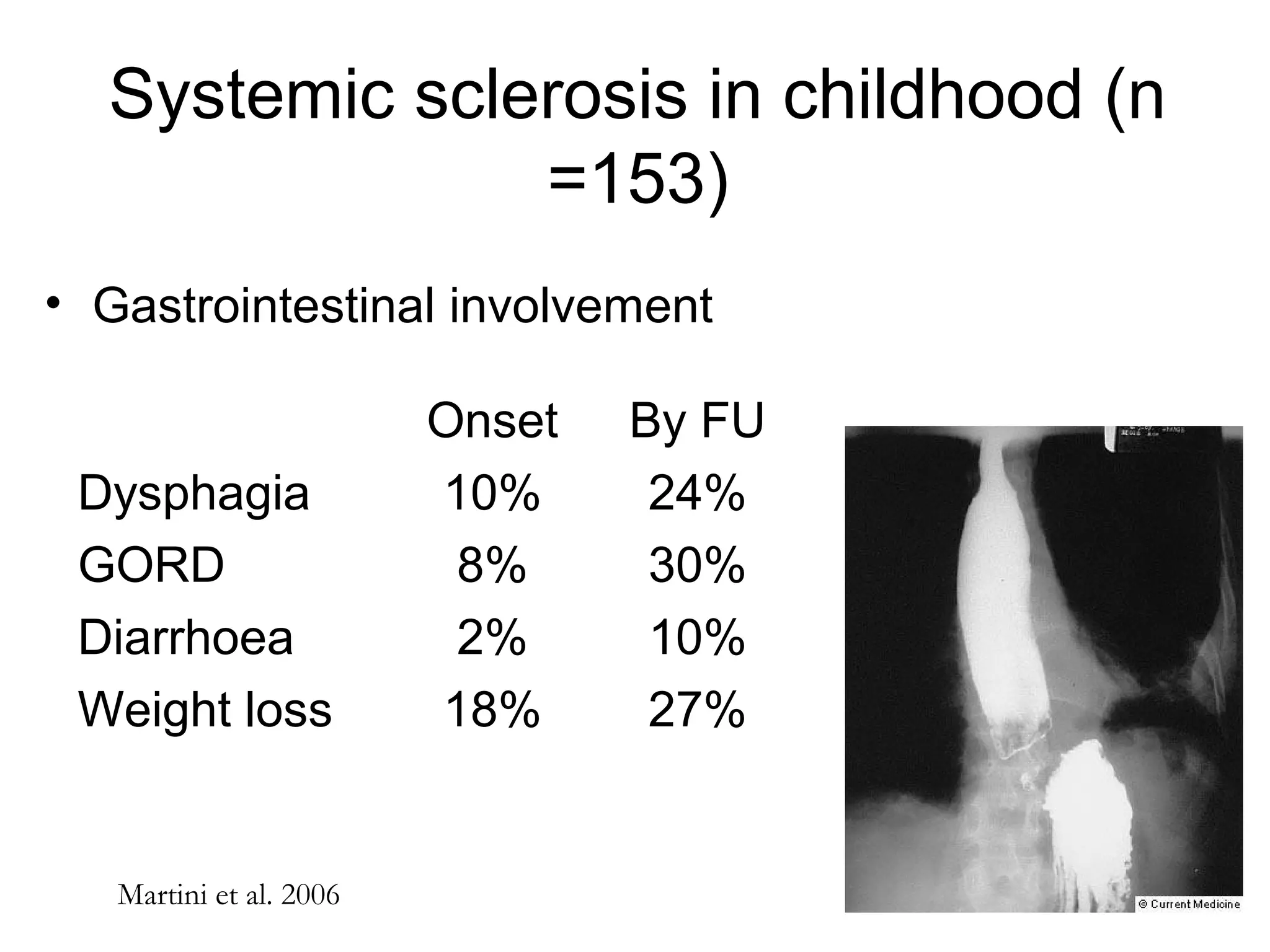 Scleroderma in children and young people | PPT