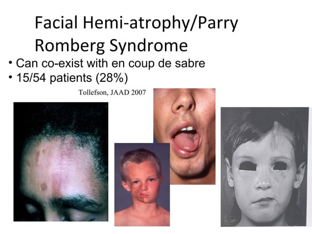 Scleroderma in children and young people | PPT | Brain and Nervous ...