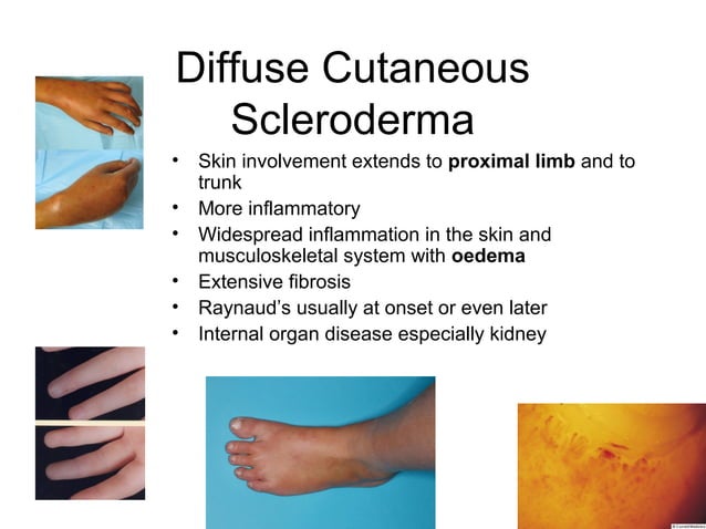Scleroderma in children and young people | PPT | Brain and Nervous ...