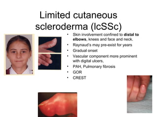 Scleroderma in children and young people | PPT