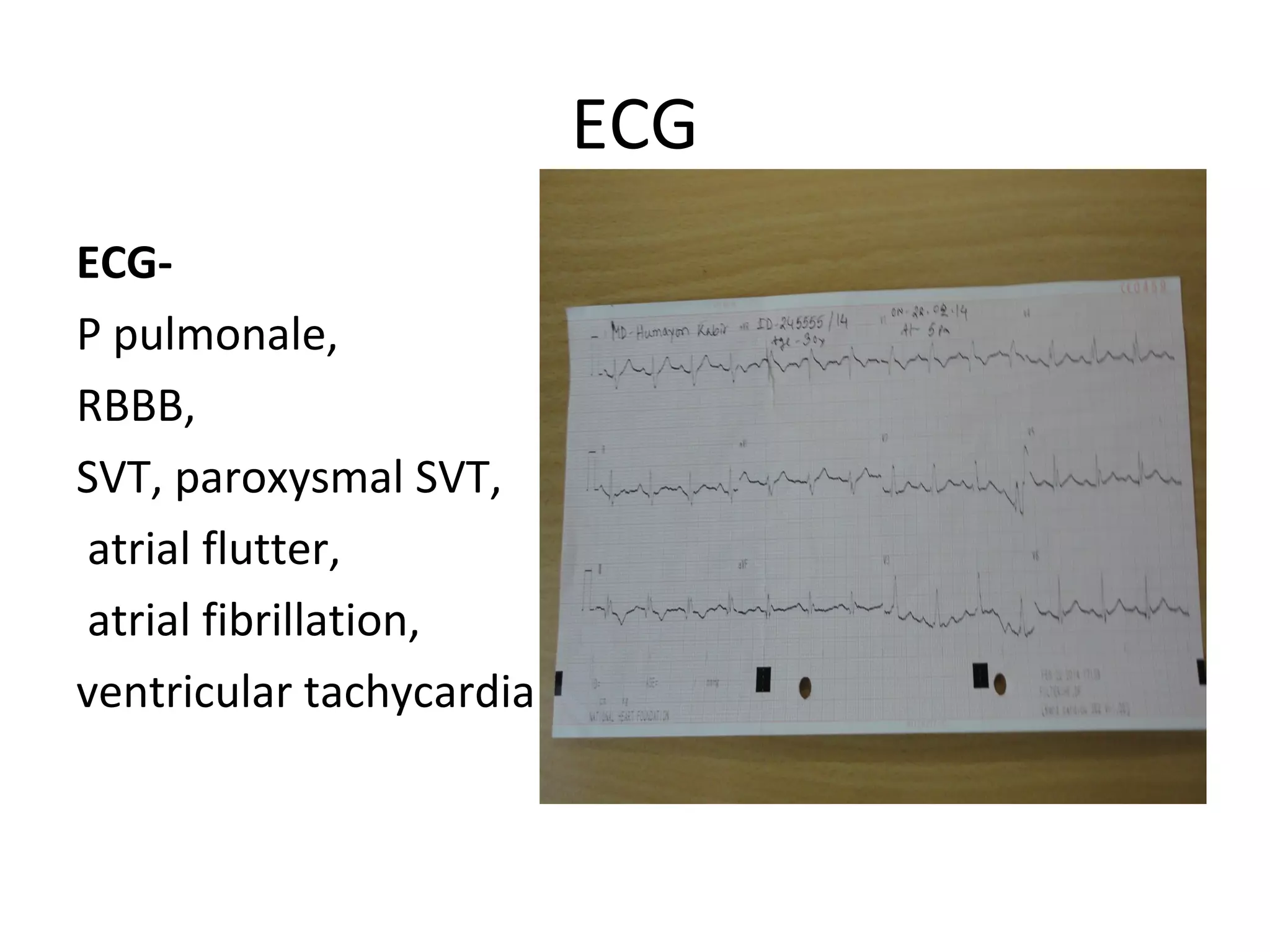 ebstein's anomali | PPT