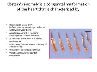 ebstein's anomali | PPT