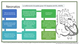 Anomalia de ebstein, anestesia en pediatria.pptx