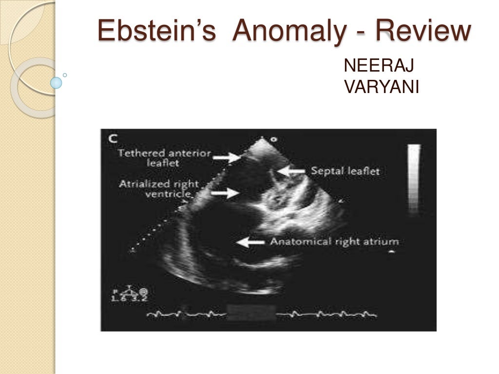 Ebstein anomaly