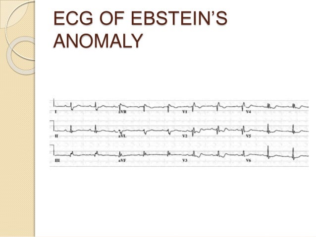 Ebstein anomaly