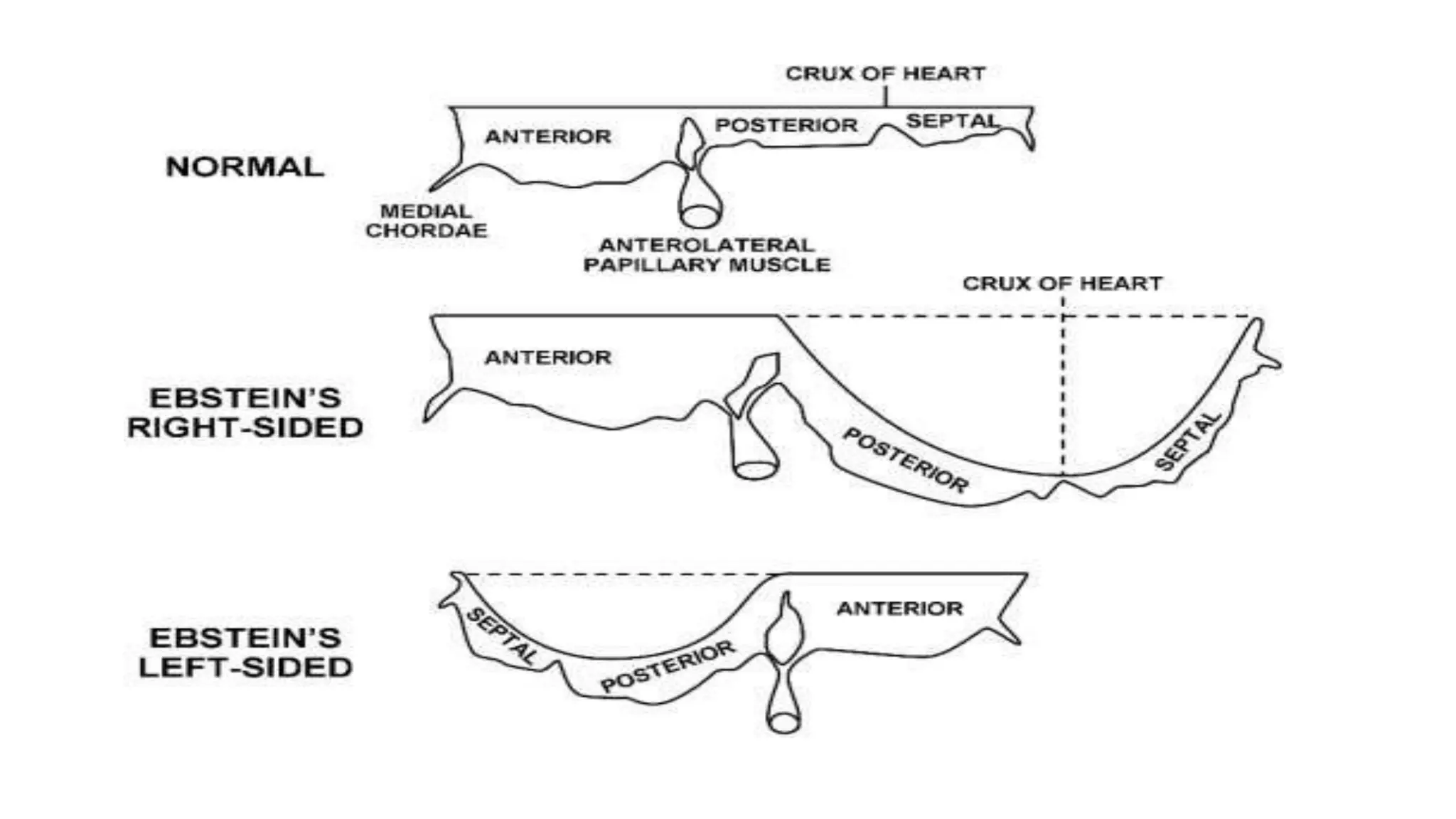 Ebstein anomaly | PPTX