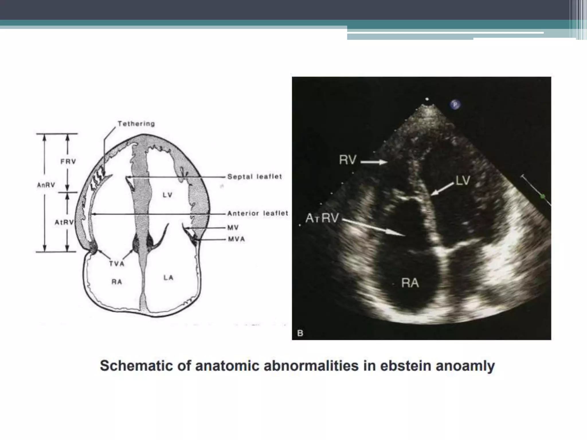 Ebstein anomaly | PPTX