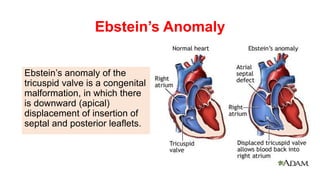 Cardiac Implantable Electronic Devices In Ebstein Anomaly:, 58% OFF