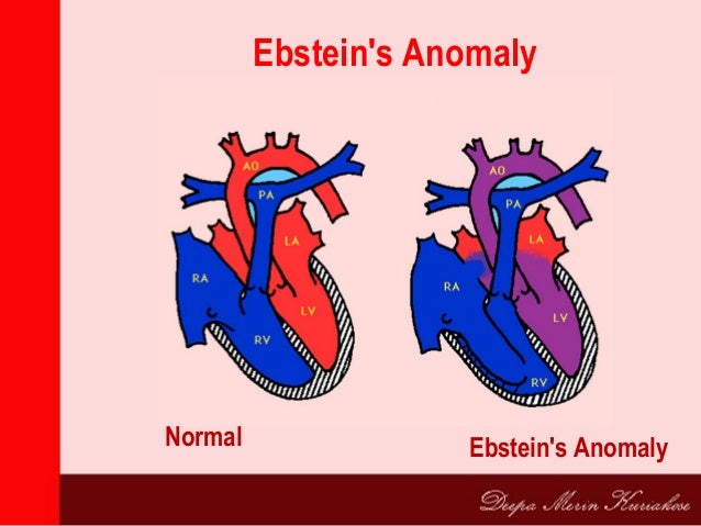 Ebstein Anomalie