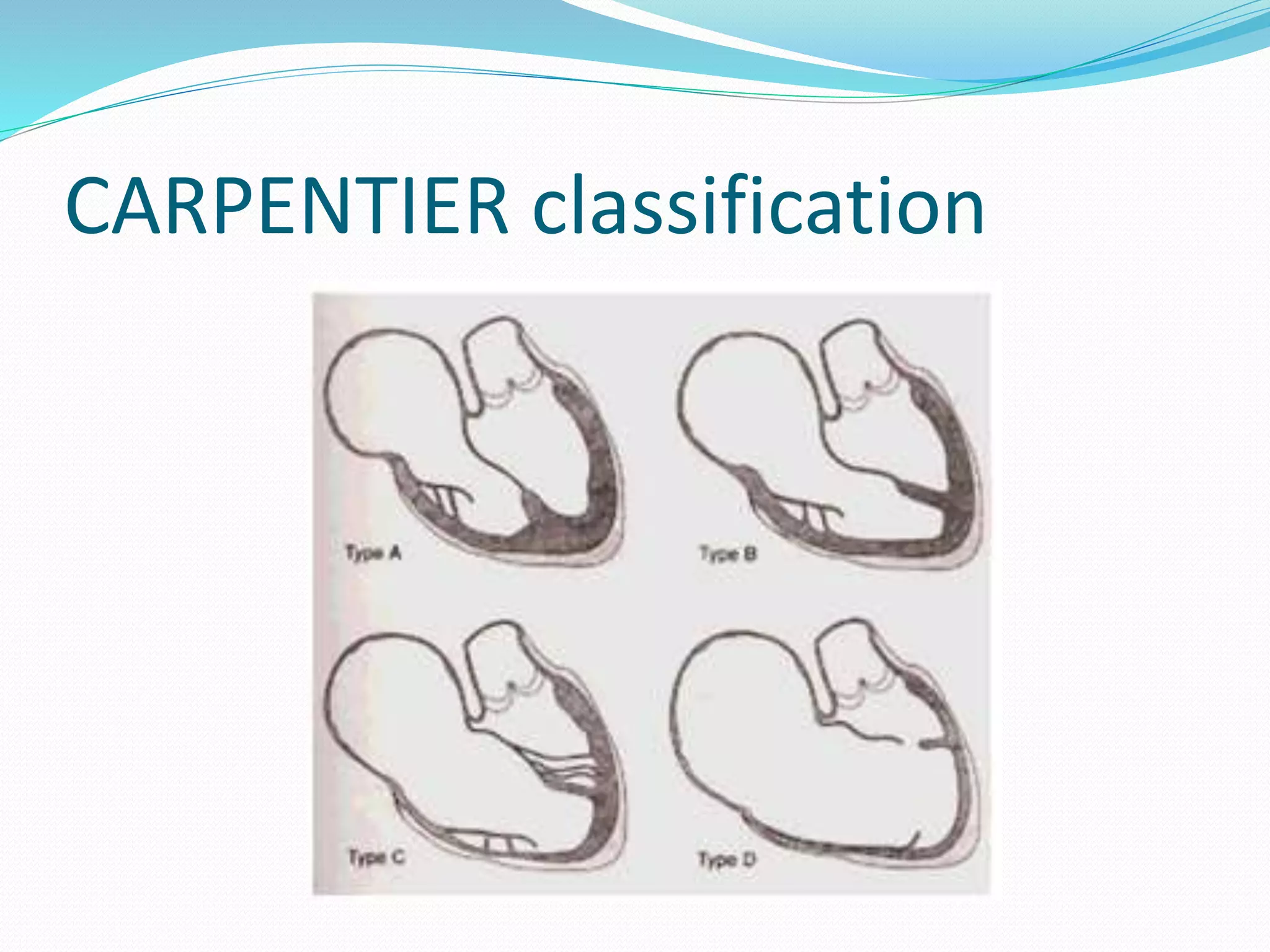 Ebstein's anomaly echocardiogram | PPTX