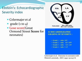 Ebstein's anomaly echocardiogram | PPT