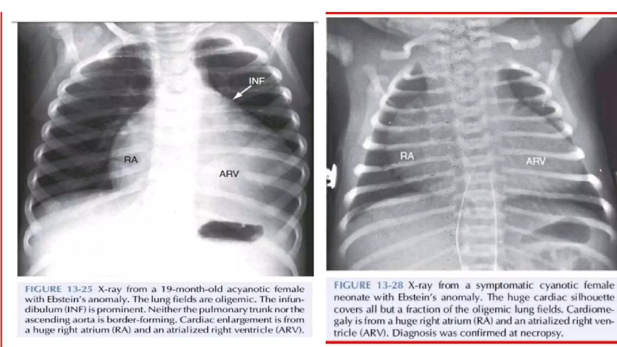 EBSTEINS ANOMALY.pptx