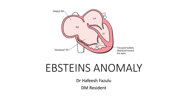 Ebsteins anomaly dr hafeesh fazulu | PPT