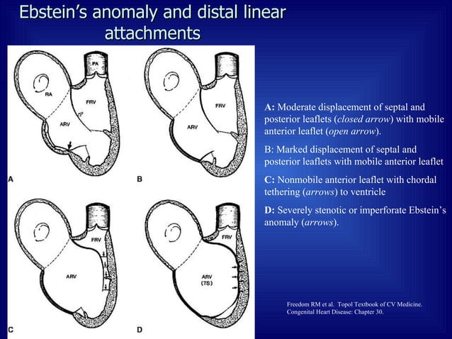 Ebsteins Anomaly | PPT