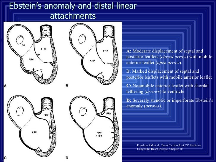 Ebsteins Anomaly