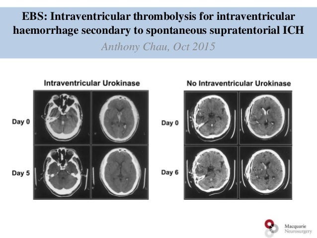 Ebs tpa for ivh ich