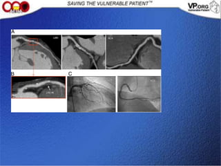 Aha 2009 v_plaque_characterization | PPTX