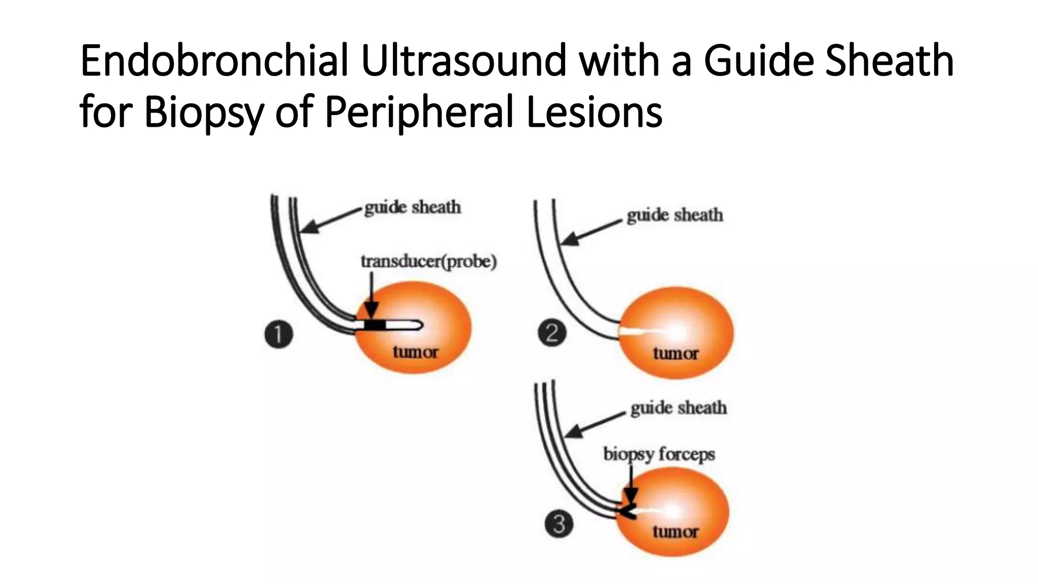 Endobronchial ultrasound - EBUS | PPTX