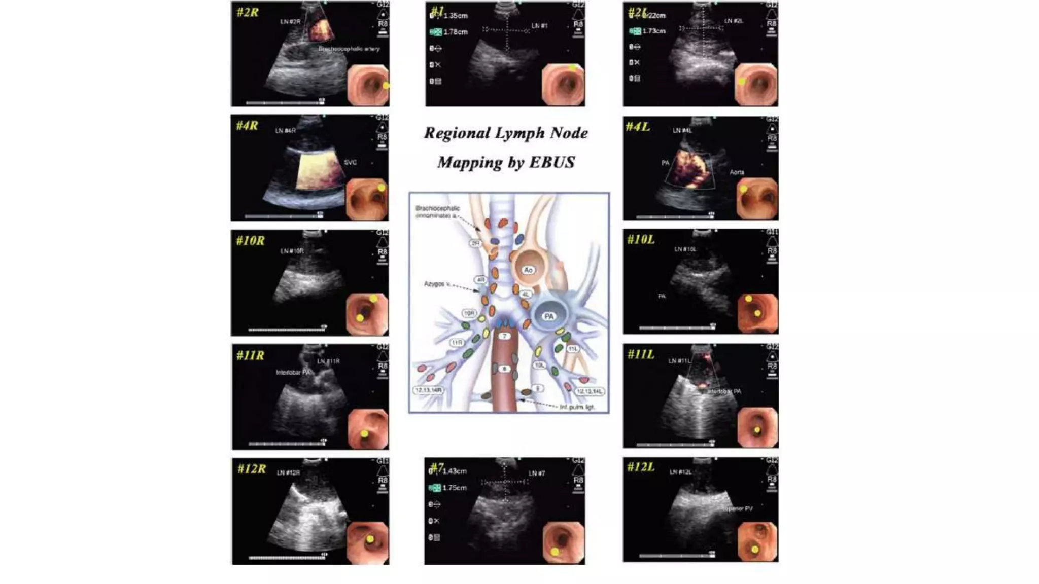 Endobronchial ultrasound - EBUS | PPTX