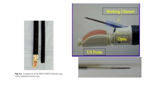 Endobronchial ultrasound - EBUS | PPTX