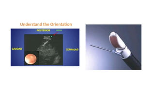 Endobronchial ultrasound - EBUS | PPTX