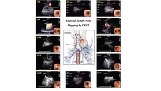 Endobronchial ultrasound - EBUS | PPTX